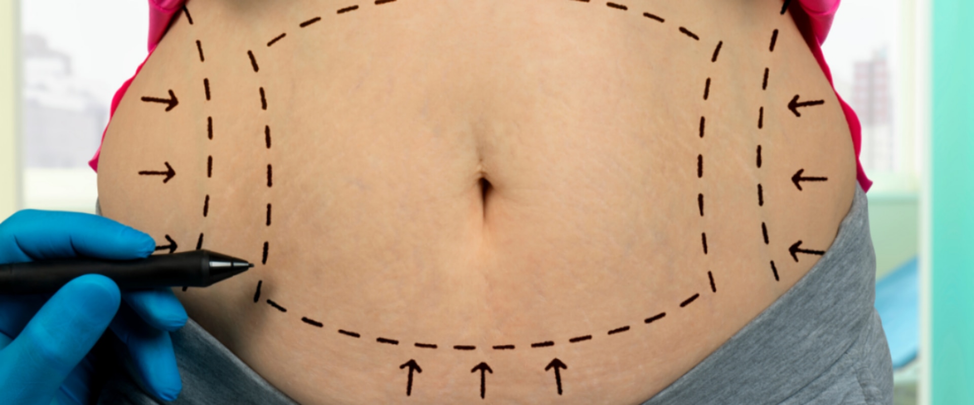 The Benefits of Non Surgical Liposuction: A Comprehensive Guide